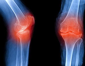 Orthopaedics & Joint Surgery Hospital in Pun - Joint Replacement ...